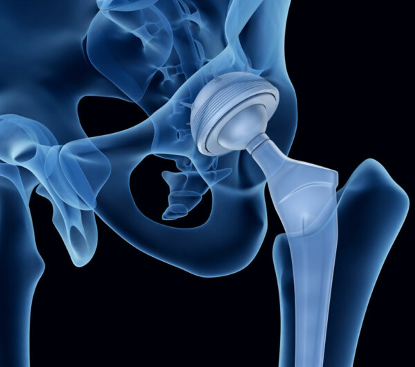 XEBEC - Innovative Deburring & Finishing for Medical Manufacturing